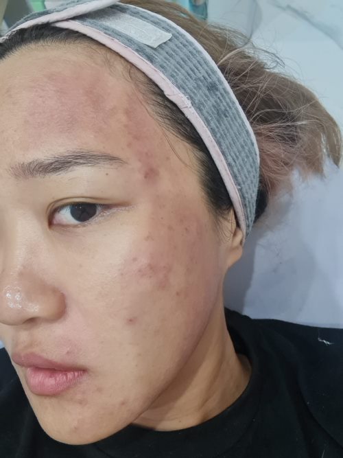 อุทาหรณ์ กดสิว เลเซอร์ นึกว่าหน้าจะใส ได้หน้าไหม้แทน ร้องแล้วไม่คืบ ...